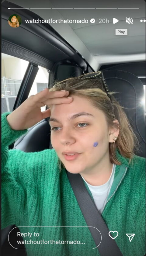 Boutons d'acné : Louane a trouvé la solution parfaite pour faire ...